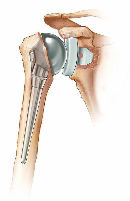 Total Shoulder Replacement
